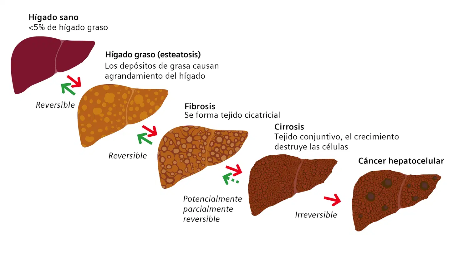 Guía de Práctica Clínica de la Esteatosis Hepática Metabólica - SAEDYN